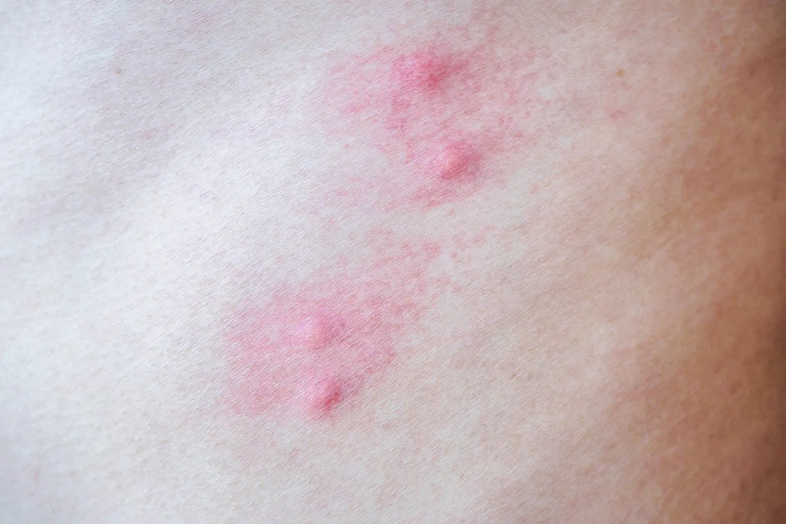 Wundrose nach Insektenstich | Symptome erkennen